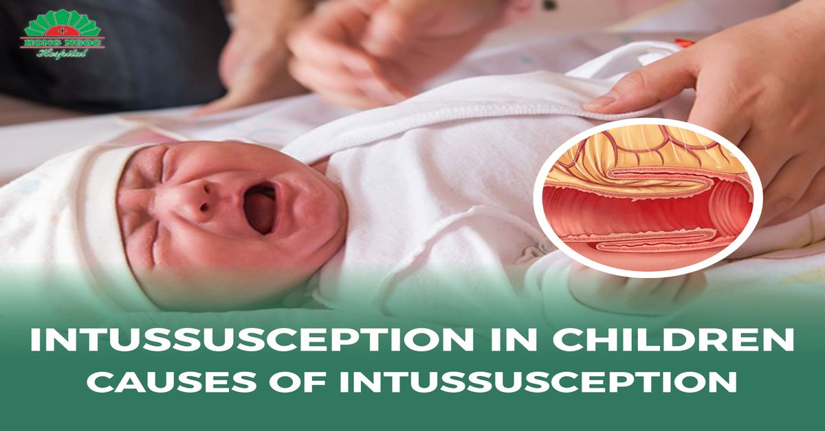 Intussusception in children: Causes of intussusception