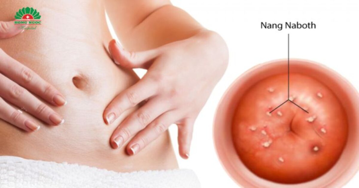 Nang naboth cổ tử cung: dấu hiệu, nguyên nhân và 3 biến chứng nguy hiểm