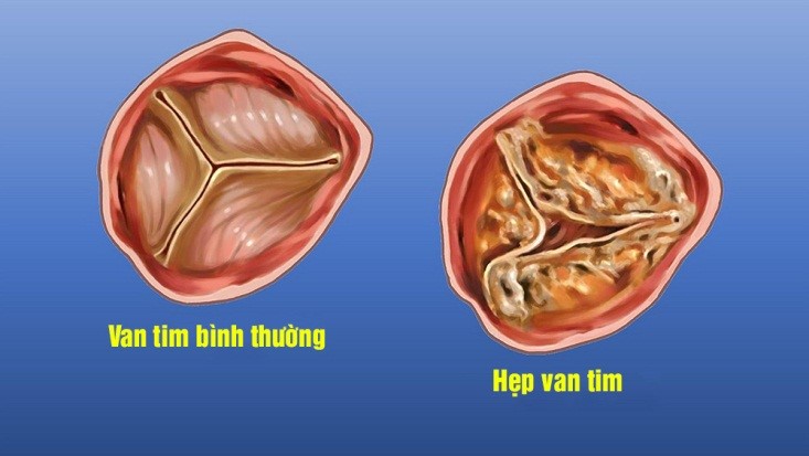 Hẹp van tim - bệnh lý tim mạch nguy hiểm: cách điều trị và phòng tránh