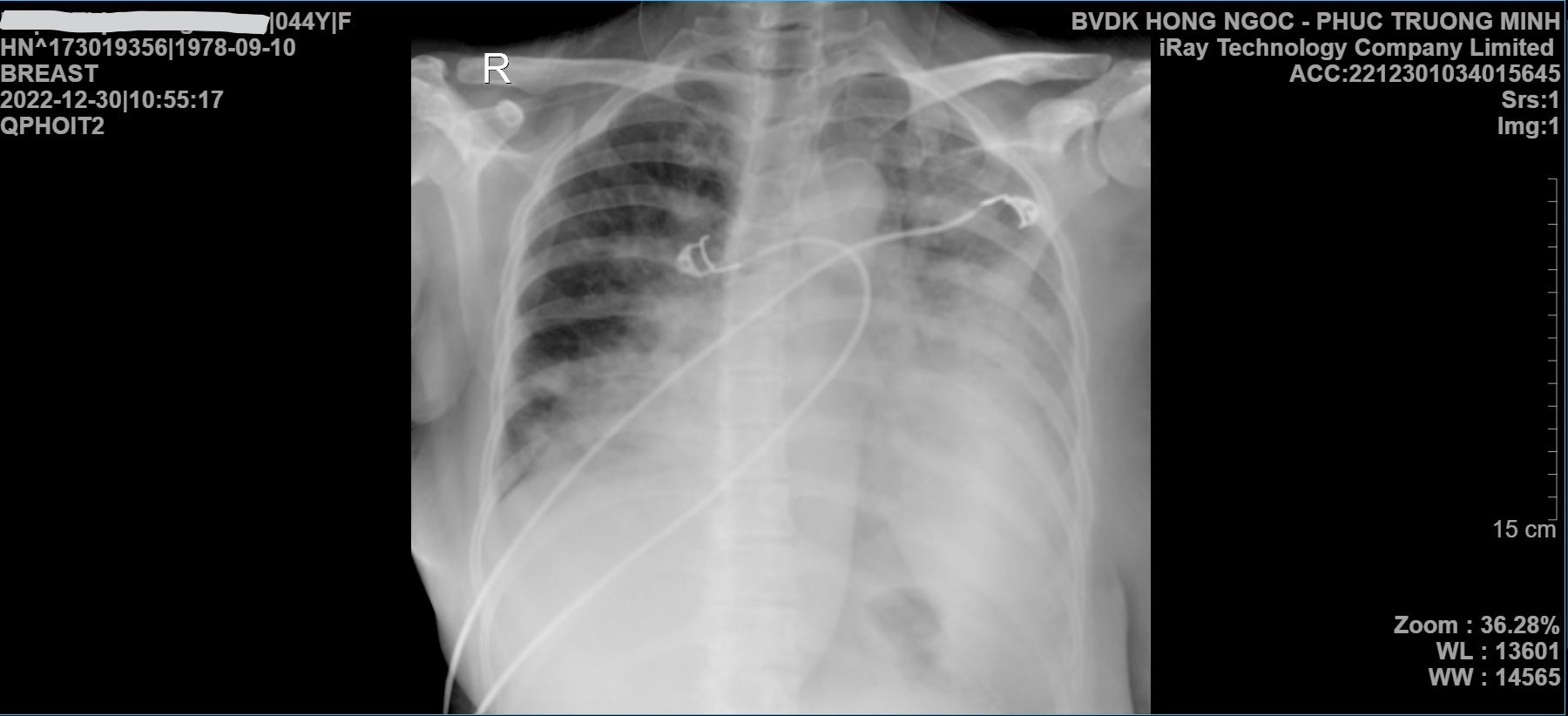 Cấp cứu giành giật sự sống cho bệnh nhân suy hô hấp cấp tiến triển (ards)