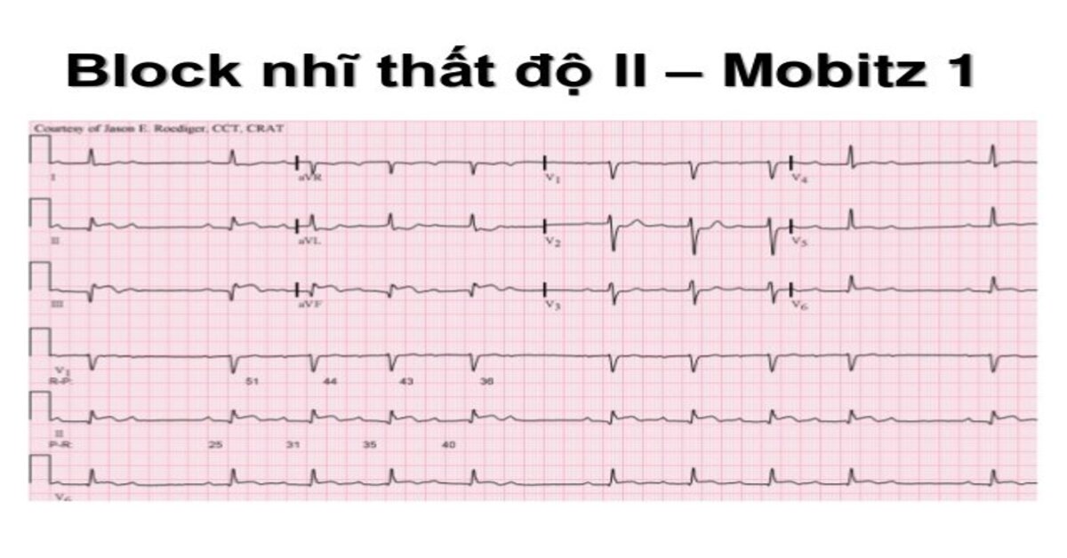 Block nhĩ thất độ 2 là gì? Có nguy hiểm không?