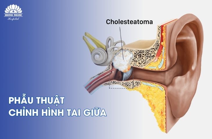 [Tổng quan] thông tin về bệnh sỏi ống mật